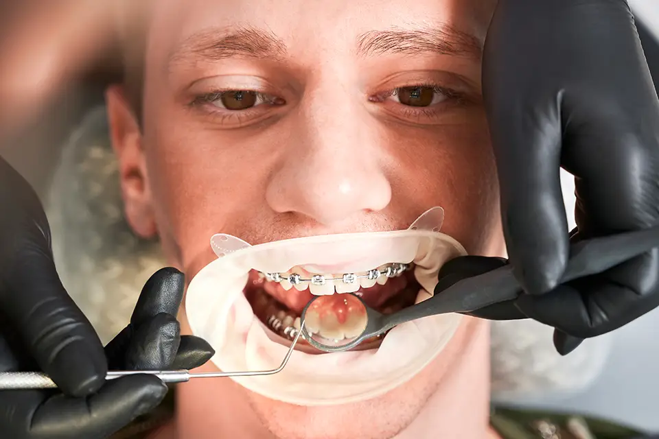 Pre-Prosthetic Surgery -ORIS Dental - Ontario - 647 367 6747